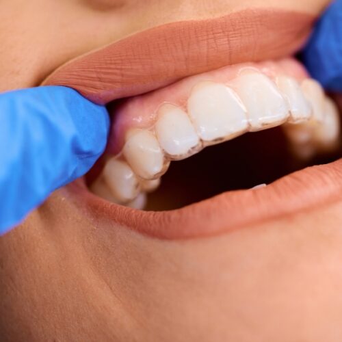 Invisalign & Retainers - Weininger Dental