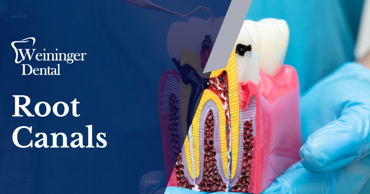 Root Canals - Weininger Dental